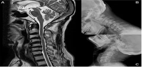 mri cervical spine nhs